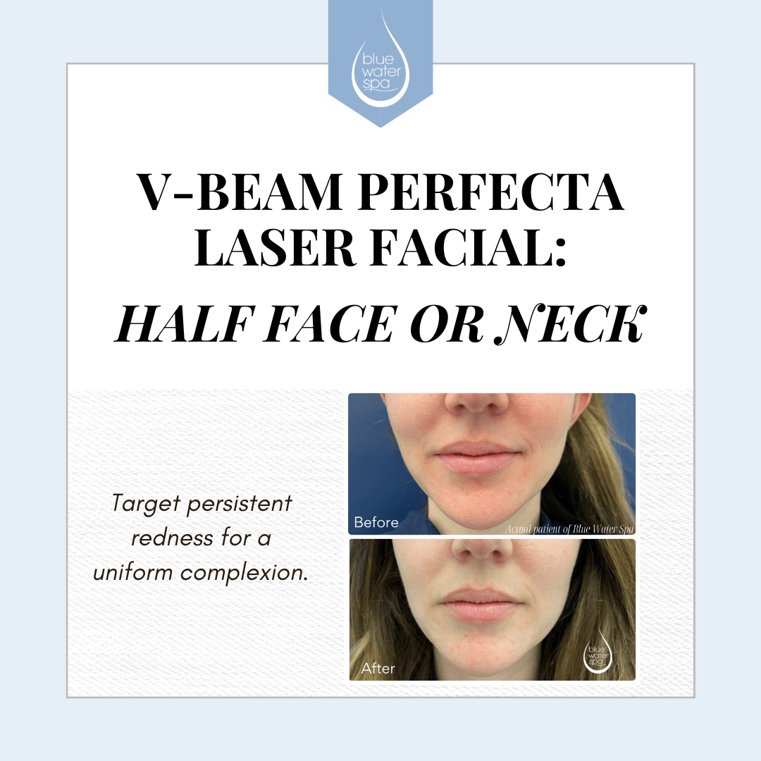 Best Laser Treatments for the Face | V-Beam Perfecta at Blue Water Spa