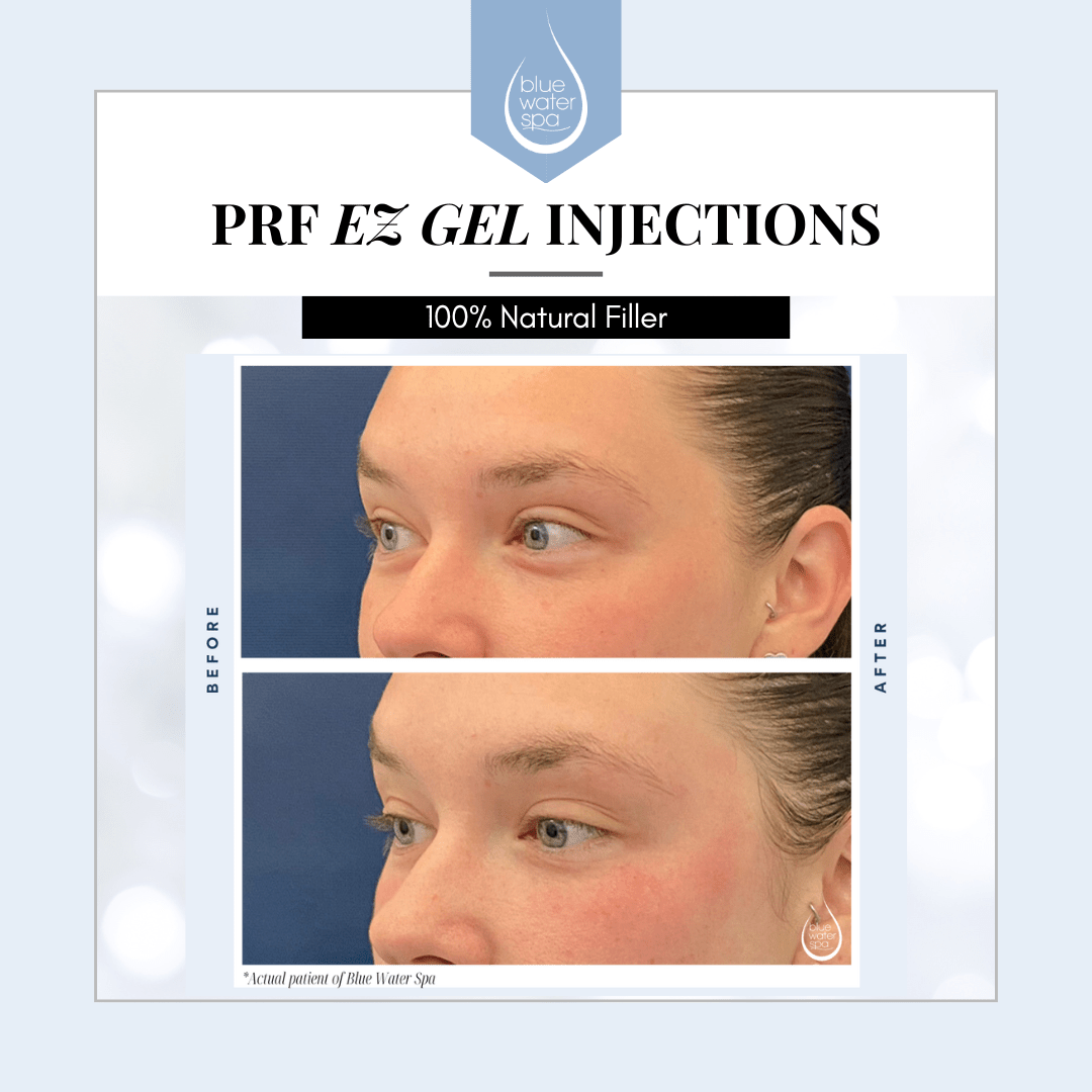 PRF Skin Rejuvenation | PRP Injections at Blue Water Spa