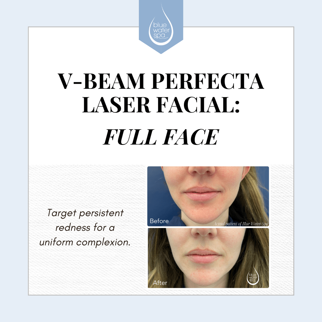 Best Laser Treatments for the Face | V-Beam Perfecta at Blue Water Spa