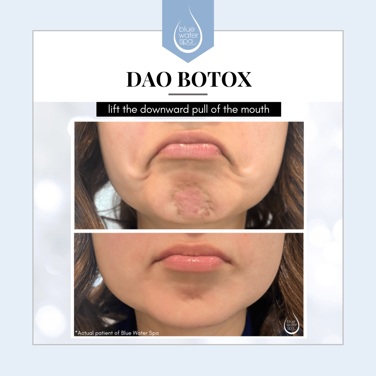 Botox for DAO Lines – Blue Water Spa