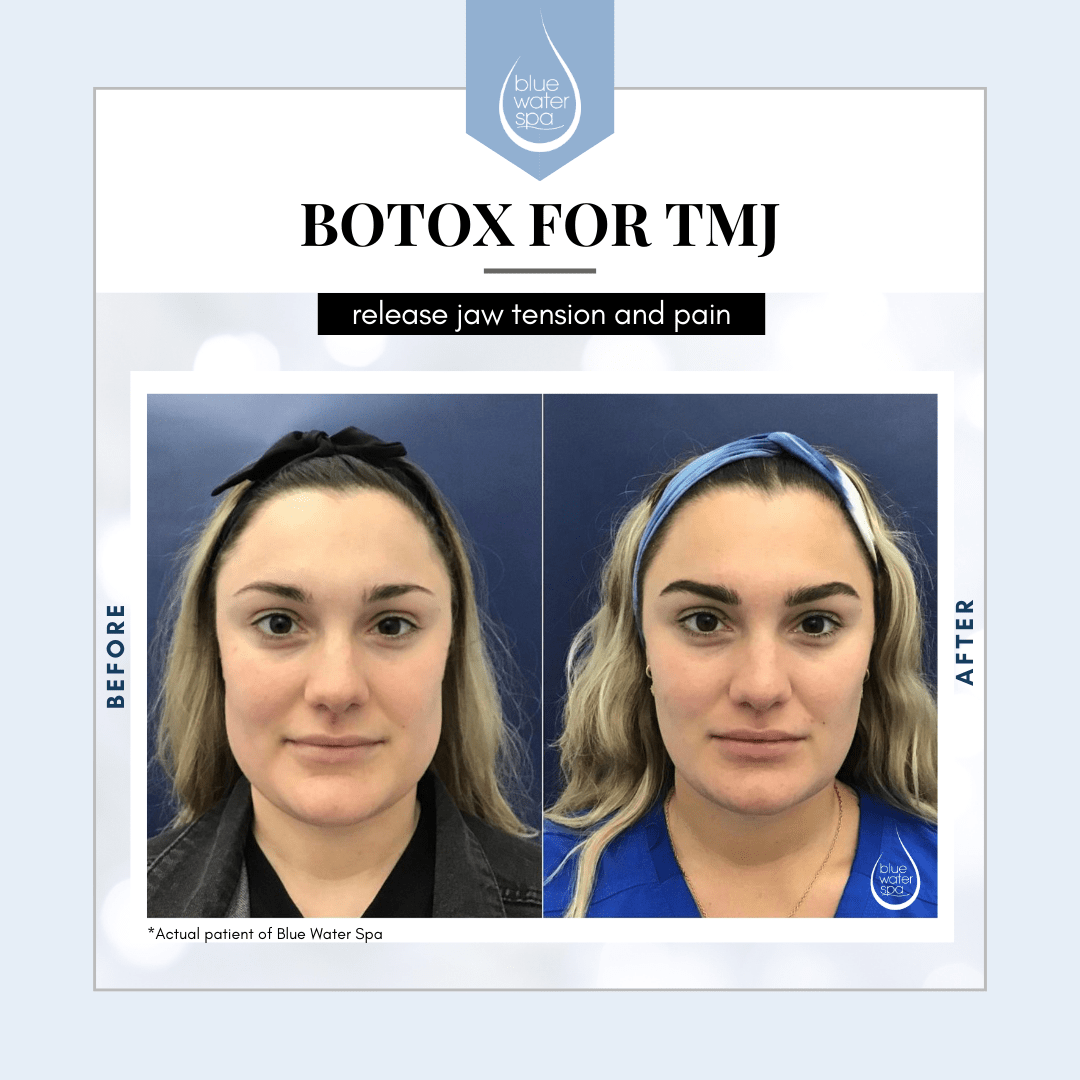 Tratamientos de Botox® para ATM y Bruxismo | Spa de agua azul en ...