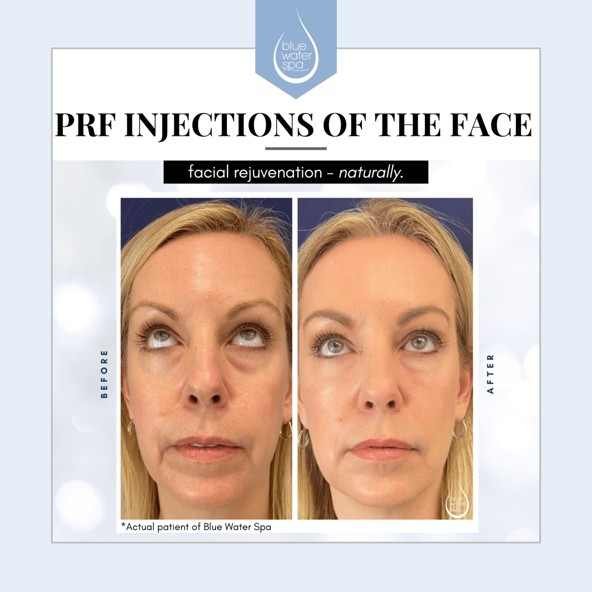 PRF Skin Rejuvenation | PRP Injections at Blue Water Spa