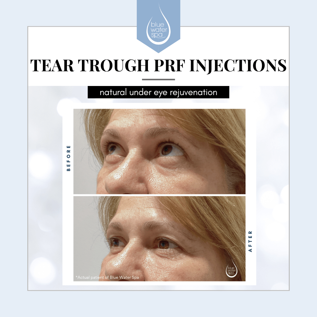 PRF Eye Area Rejuvenation | PRP Injections at Blue Water Spa