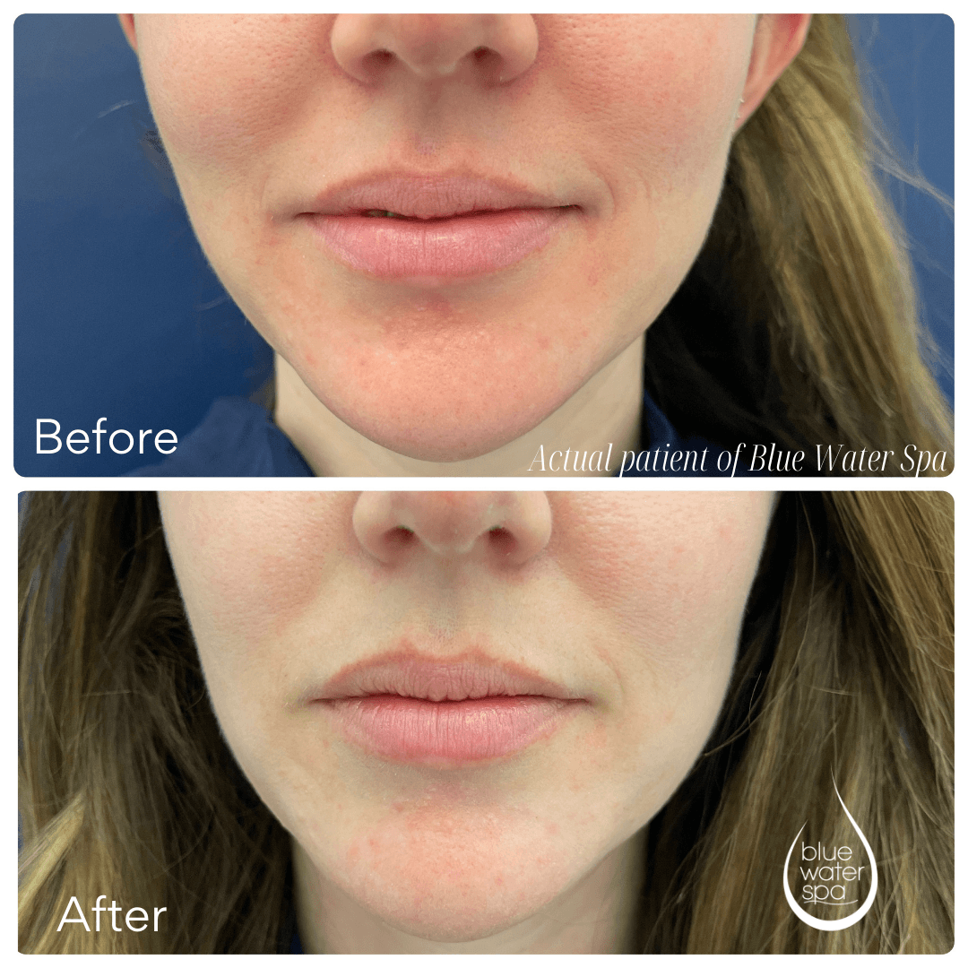 Best Laser Treatments for the Face | V-Beam Perfecta at Blue Water Spa