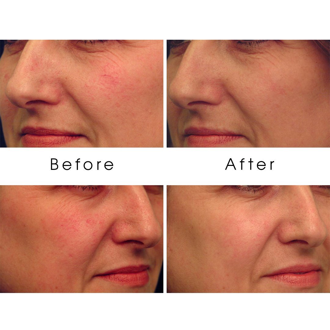 Best Laser Treatments for the Face | V-Beam Perfecta at Blue Water Spa