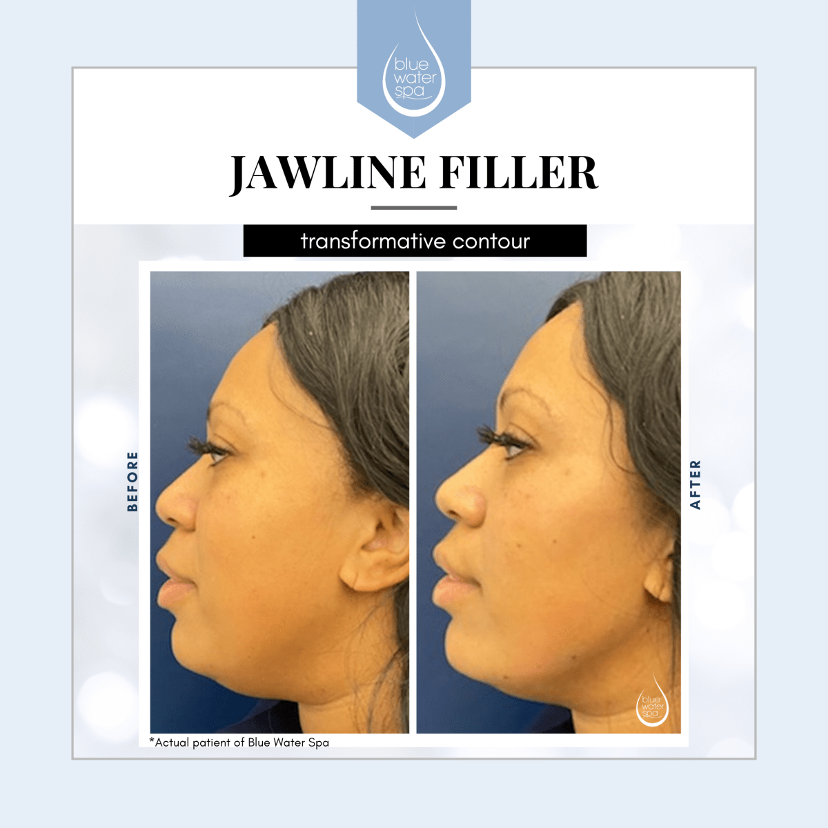 Jawline Filler Everything You Need To Know About Chin Filler